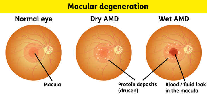 What is macular degeneration? Causes, symptoms and treatment options ...